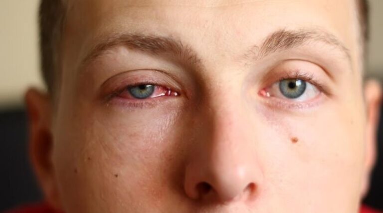 Olho inchado: conheça causas e quando pode ser sinal de problema grave